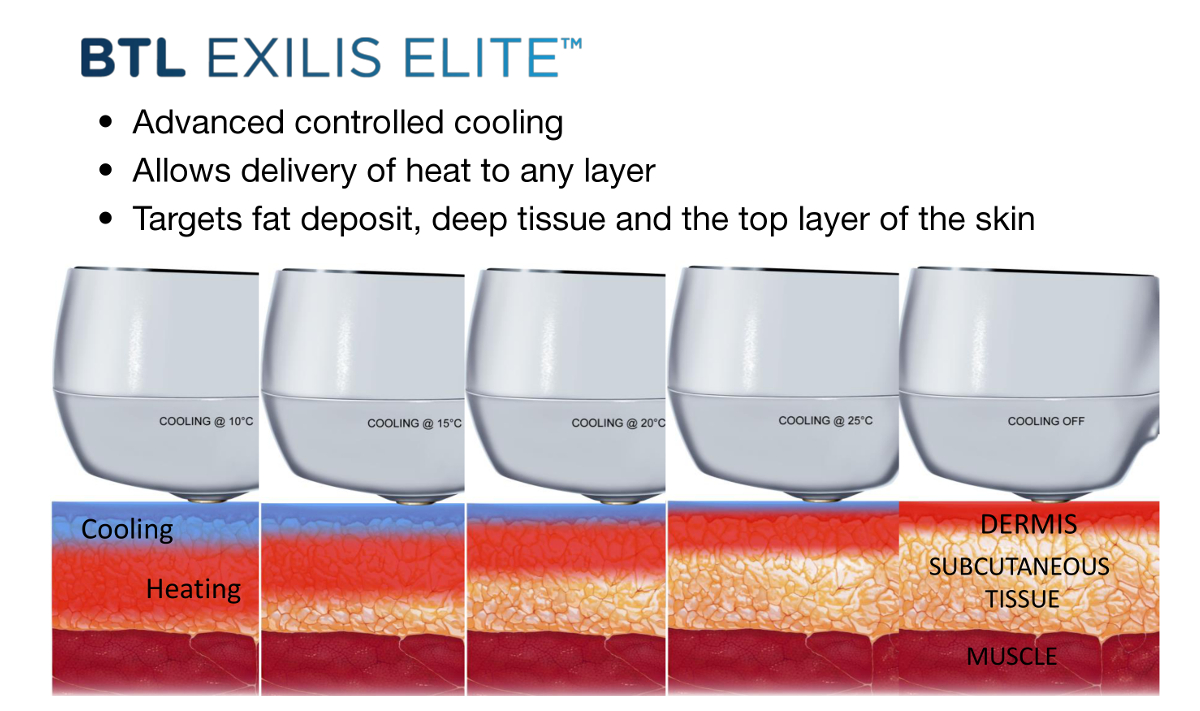 BTL Exilis Elite Fat Reduction, Skin Tightening in Singapore