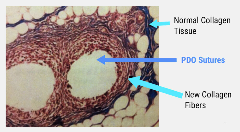What is a PDO Thread Lift?