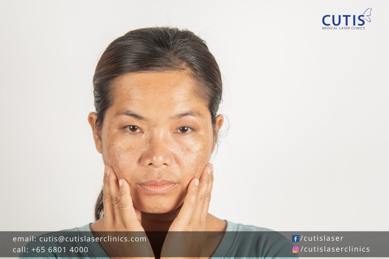 How Hormones Affect Your Skin | Cutis Laser Clinics