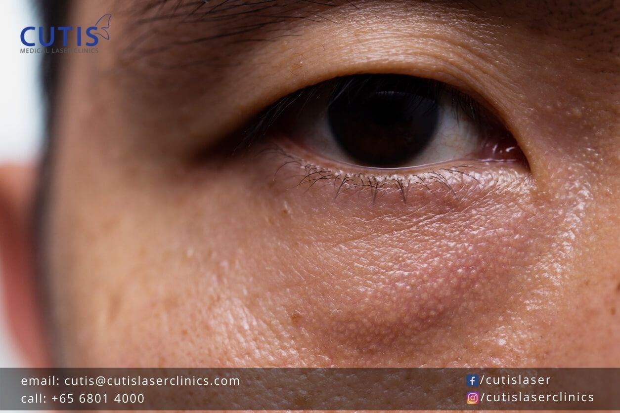 PLASMAGE® for Droopy Eyelids - Aesthetic Clinics in Singapore