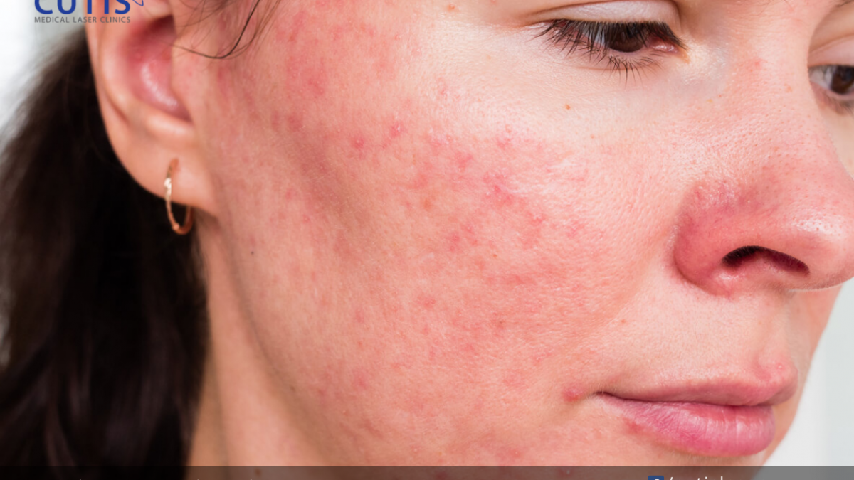 Bumps On Skin That Look Like Pimples