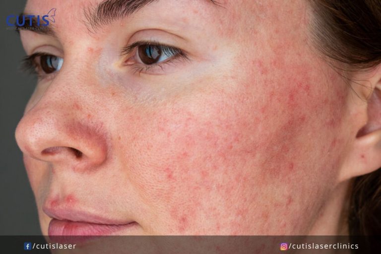 Do You Have Blotchy Skin?