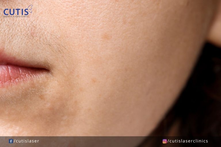 How to Get Rid of Your Peach Fuzz