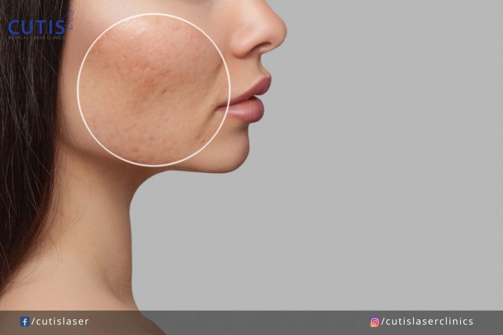 Improve Your Skin’s Texture with These Cutis Treatments