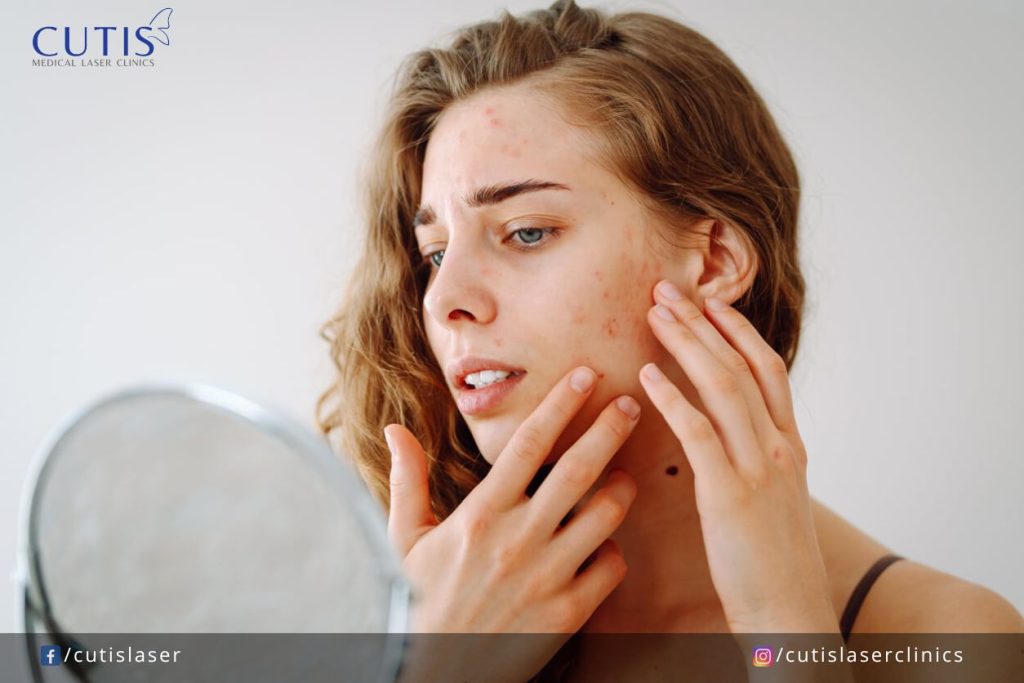 5 Things You Need to Know About Hyperpigmentation